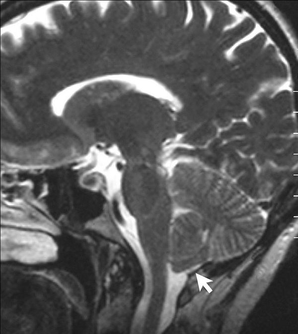 Chiari malformation - MEpedia