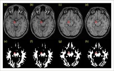 Neurology of ME/CFS - MEpedia