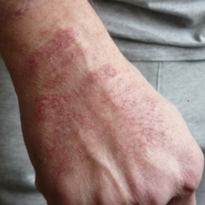 Electrohypersensitivity - MEpedia